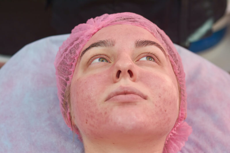 Lupus Symptoms in Women: Causes, Diagnosis and Treatment
