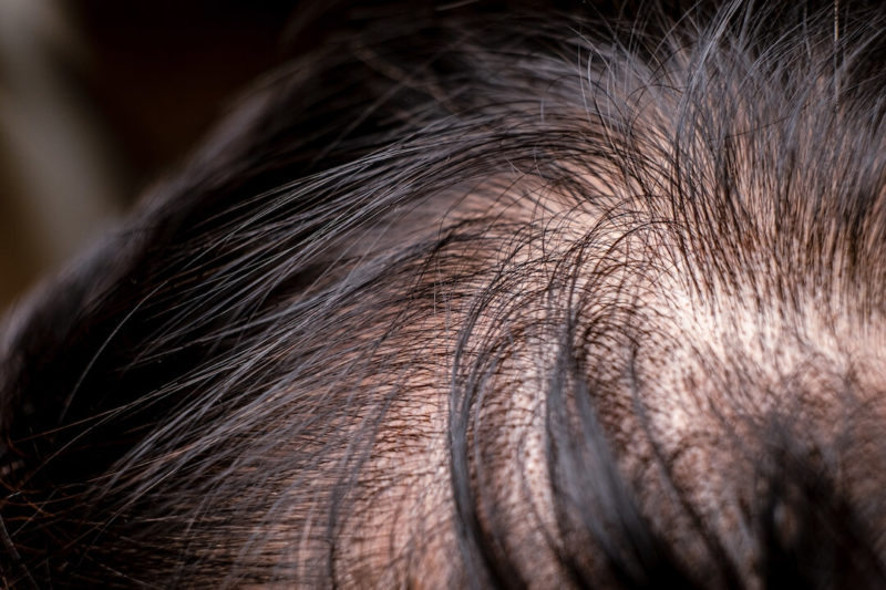 Is Hair Loss Normal? Discover the 8 Causes and Treatment
